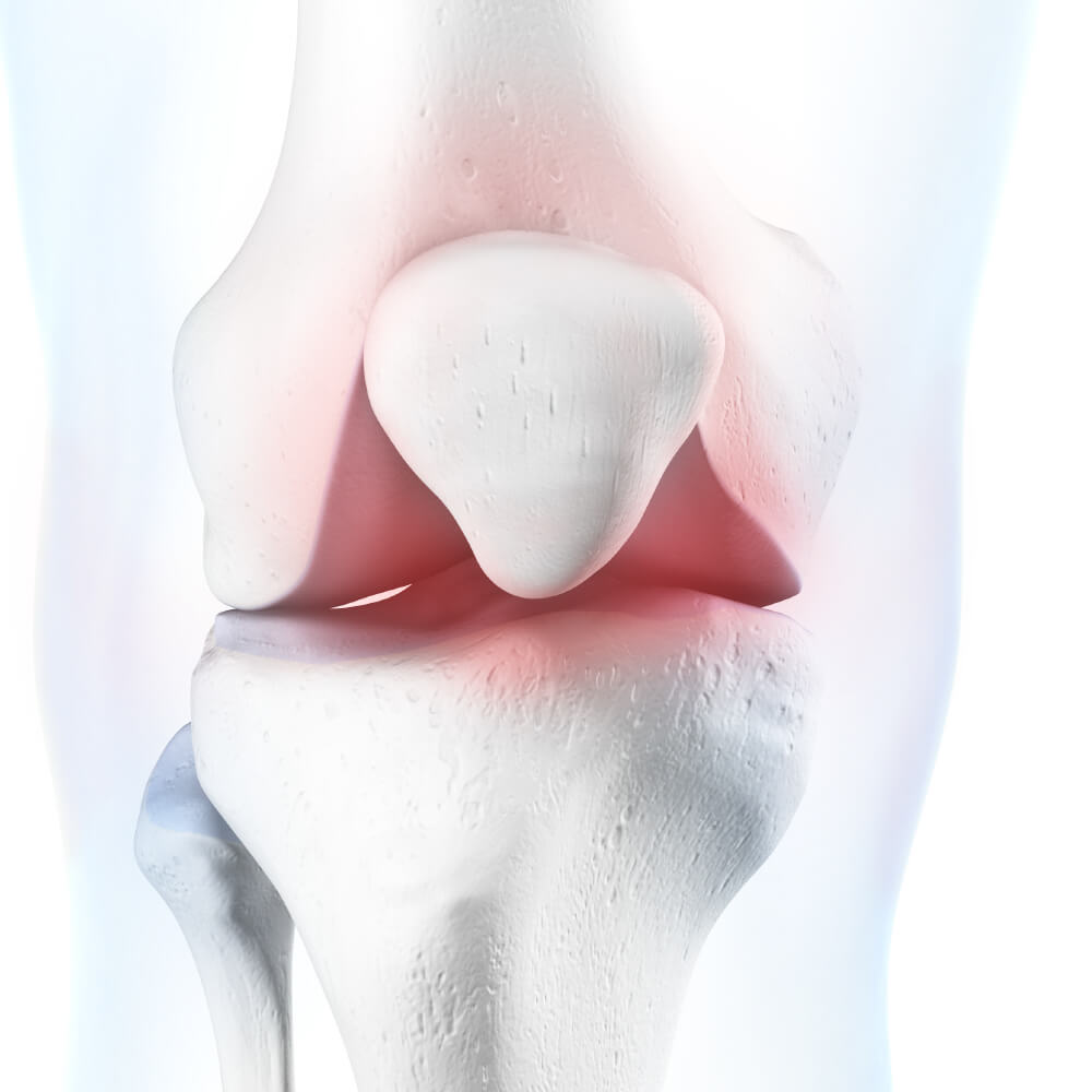 Causes, Symptoms & Treatment | Runner's Knee | Bauerfeind