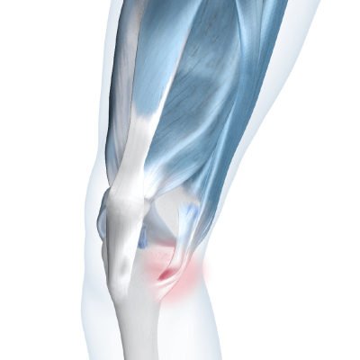 What to know about Pes Anserine Bursitis | Bauerfeind